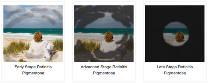 רטיניטיס פיגמנטוזה (RP - Retinitis Pigmentosa) - מרכז הידע